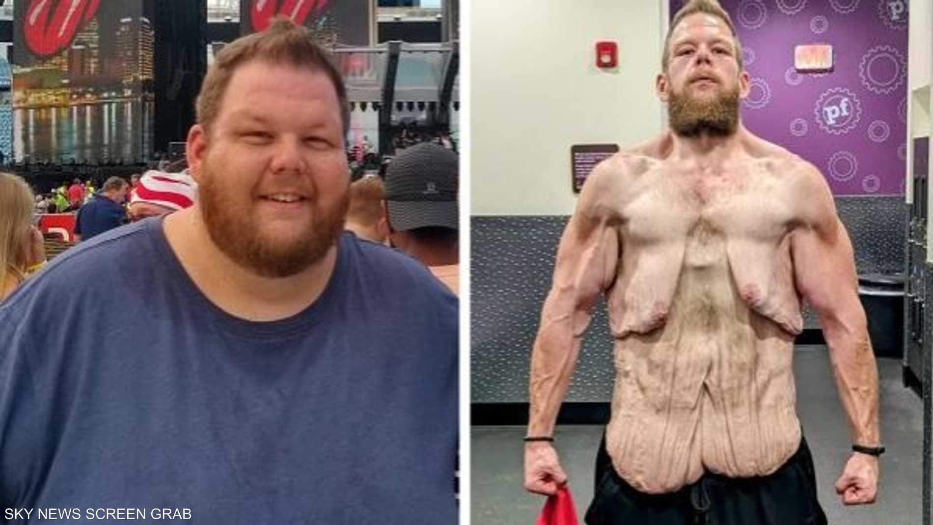 سكاي نيوز عربية | بجسد مترهل.. صورة صادمة لرجل خسر 152 كيلو من وزنه